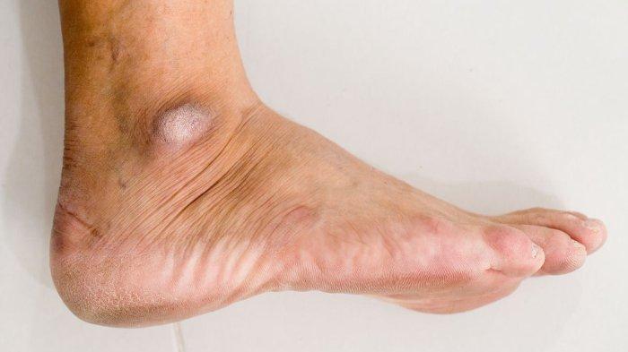 4 Tips Memutihkan Mata Kaki yang Hitam dan Terasa Kering, Lebih Cerah ...