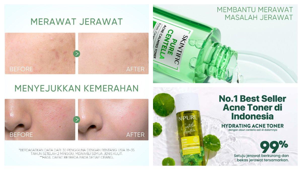 45 Rekomendasi Toner Khusus untuk Kulit Berjerawat yang Sudah BPOM ...