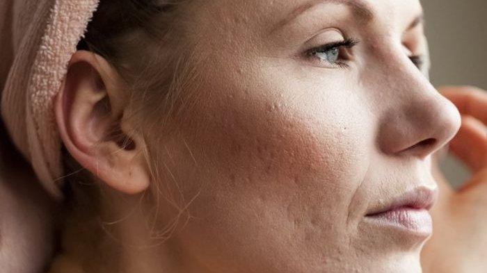 5 Bahan Alami Mampu Hilangkan Bopeng di Wajah dengan Aman ...