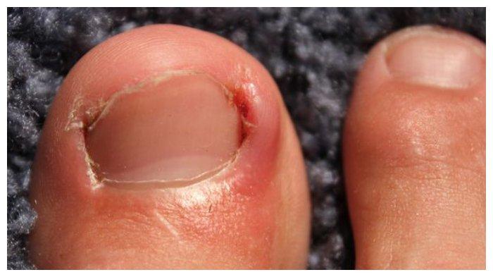 8 Cara Mudah Mengatasi Cantengan di Jempol Kaki Tanpa Harus ke Dokter ...