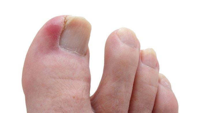 7 Cara Alami Mengatasi Jempol Kaki Cantengan, Bahannya Mudah Ditemukan ...