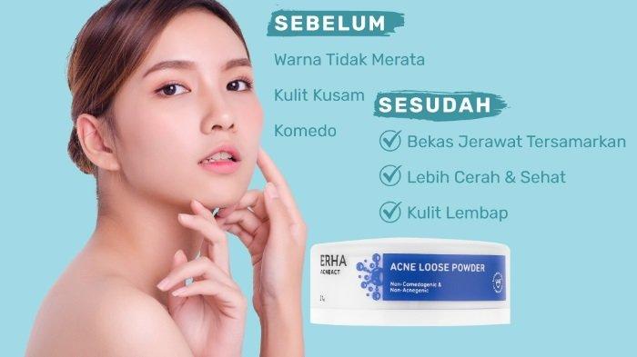 6 Rekomendasi Bedak Tabur Terbaik Khusus Acne Fighter, Aman untuk Kulit Jerawatan ...