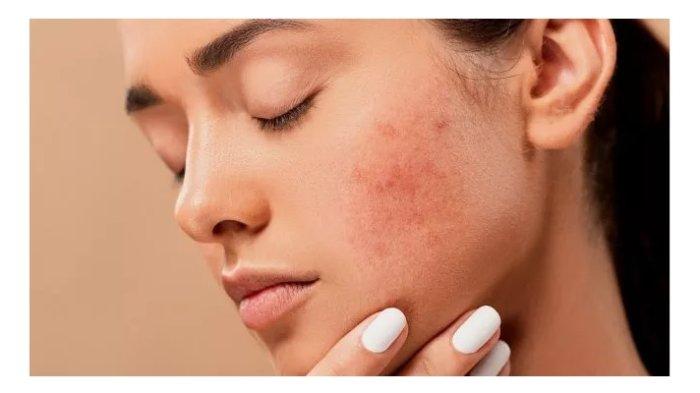 Kenali Lebih Awal, Ciri-ciri Skin Barrier Rusak dan Cara Memperbaikinya ...