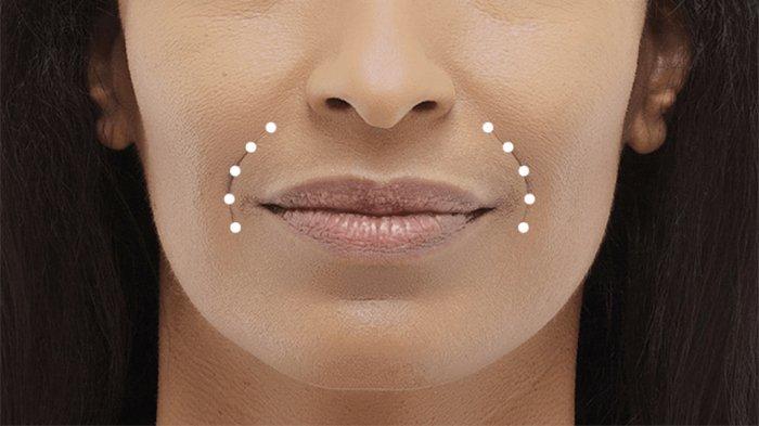 7 Cara Menghilangkan Smile Line atau Garis Senyum yang Membuat Wajah ...