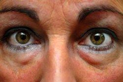 Ketahui Penyebab dan Cara Mengatasi Kantung Mata yang Kamu Alami ...