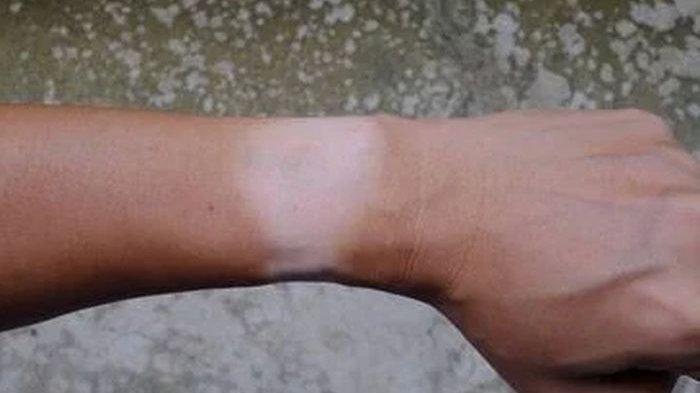 Kulit Belang Kembali Cerah dengan Perawatan Rutin Menggunakan 9 Bahan ...