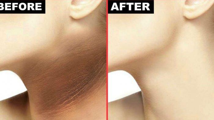 3 Bahan Alami untuk Cerahkan Leher Hitam, Begini Cara ...