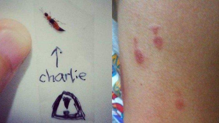 Waspada Radang Kulit Akibat Racun Tomcat Mudah Menyebar, ini Cara ...