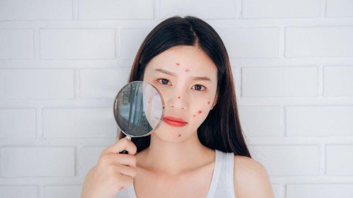 7 Rekomendasi Acne Patch Unik Menggemaskan yang Sedang Ngetren ...