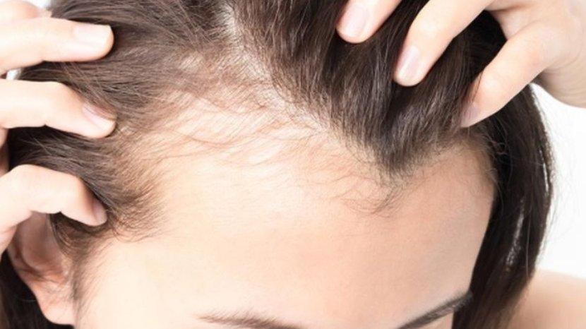 5 Cara untuk Menumbuhkan Rambut pada Area Botak - Tribunshopping.com