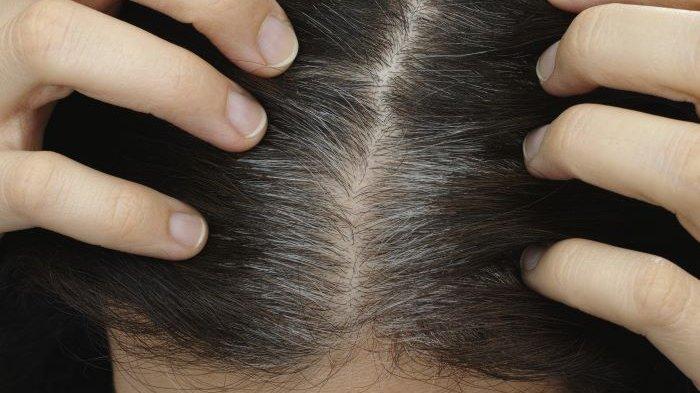 Mitos Atau Fakta? Cabut Uban Rambut Bisa Bikin Uban Makin Banyak ...