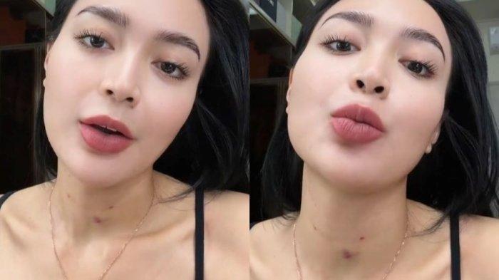 Leher Wika Salim Bikin Salfok Netizen, Kemerahan Dikira Bekas Cupang, Klarifikasinya Gak ...