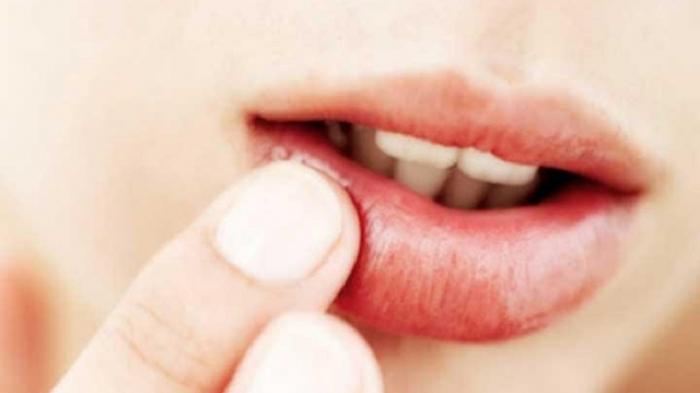 Cara Mudah Mengatasi Bibir Kering saat Puasa, Lakukan 4 Tips Berikut Ini - Tribunsolo.com