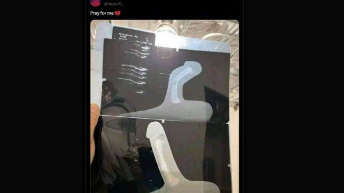 Viral Foto Rontgen Penis Patah, Begini Penjelasan Dokter Boyke ...