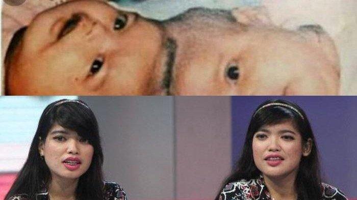Masih Ingat Kisah Yuliana dan Yuliani? Kembar Siam yang Berhasil Dipisahkan, Begini Kabar ...