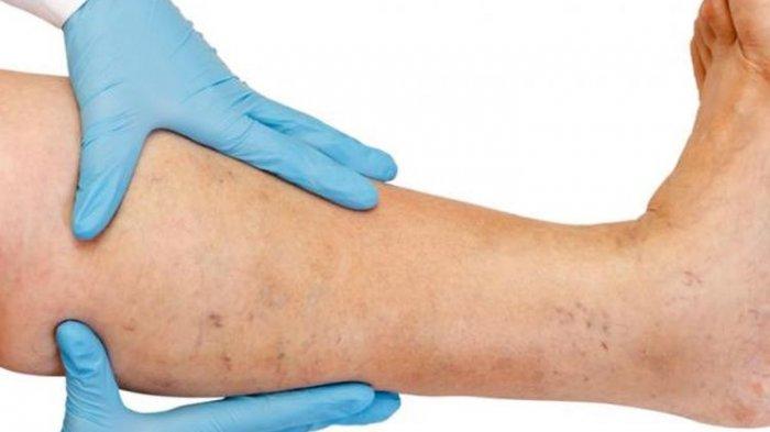 Mengenal Penyebab Varises, Pencegahan, hingga Cara Mengobatinya ...