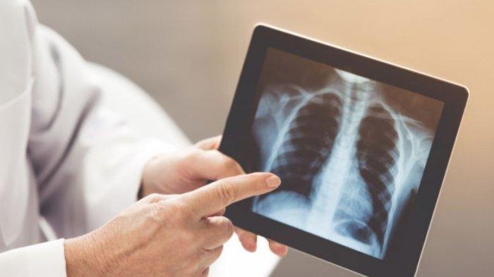 Viral Perbandingan Hasil Rontgen Paru-paru Pasien Covid-19 yang ...