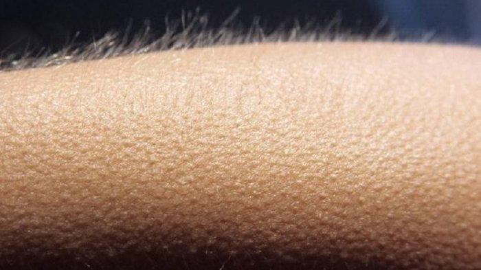 Kenali Alasan Kenapa Kulit Kita Bisa Merinding, Folikel Rambut ...