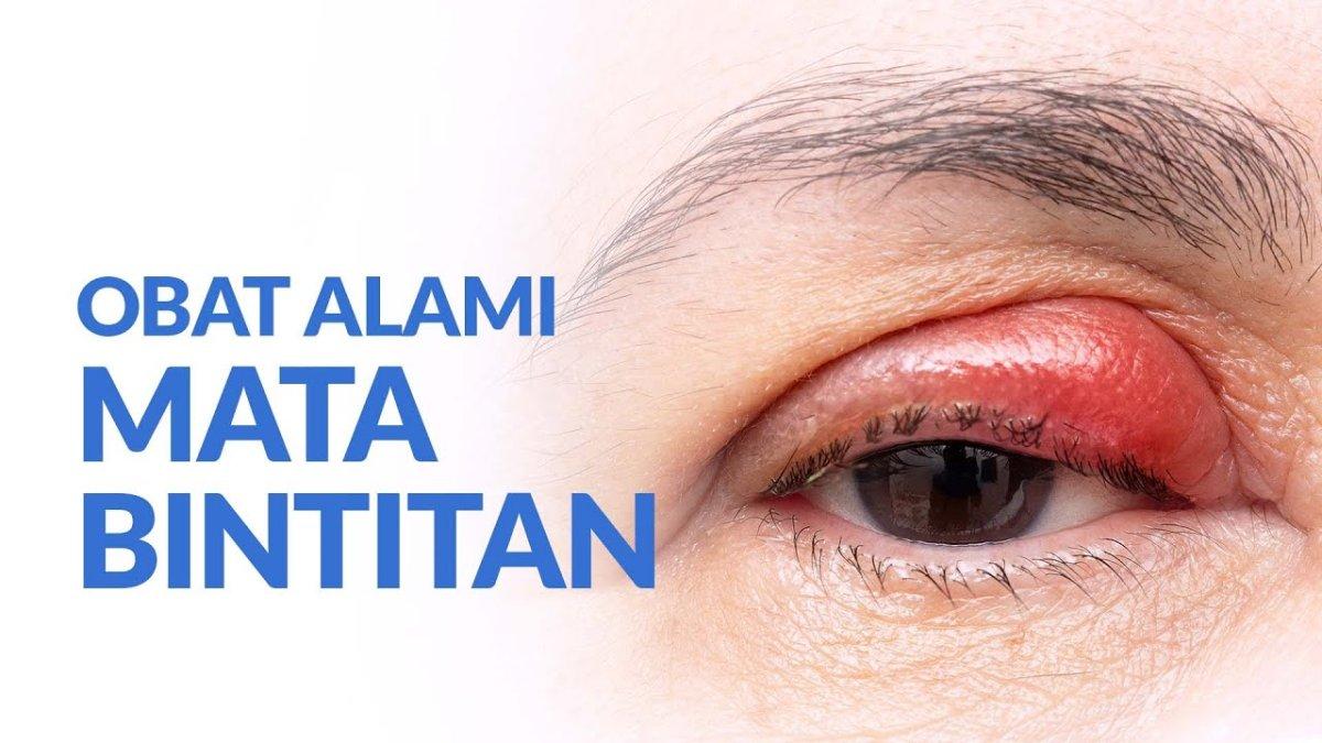 5 Cara Mudah dan Ampuh Atasi Mata Bintitan dengan Cepat, Agar Mata ...
