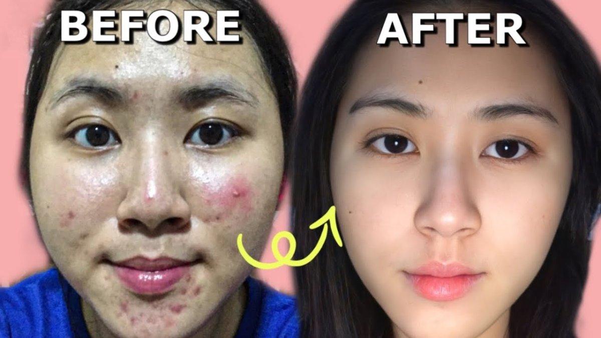 5 Cara Cepat Menyembuhkan Jerawat Batu Meradang dengan Bahan Alami ...