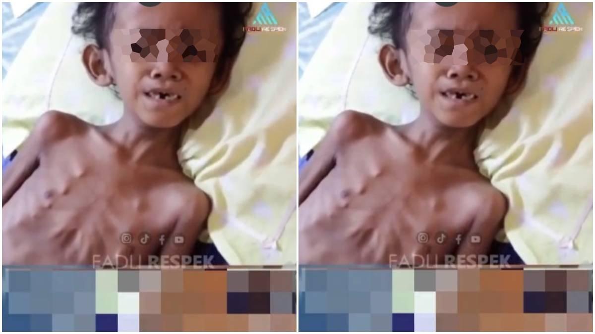Kisah Pilu Reyhan, Bocah 8 Tahun Kurus Kering Bak Tinggal Tulang Akibat Idap Penyakit Tumor ...