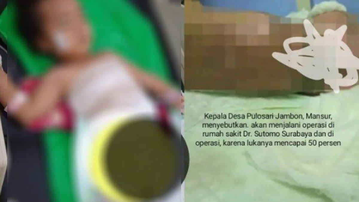 NASIB Balita di Ponorogo Kecemplung ke Kuah Panas, Kini Dirawat Intensif, Perut sampai Kaki ...