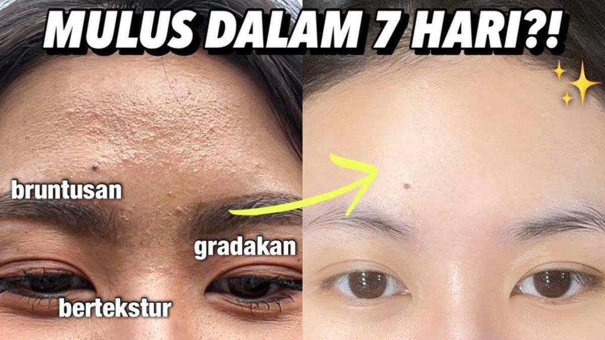 5 Cara Mudah dan Ampuh Mengatasi Muka yang Beruntusan Dengan Cepat, Agar Muka Kembali Mulus ...