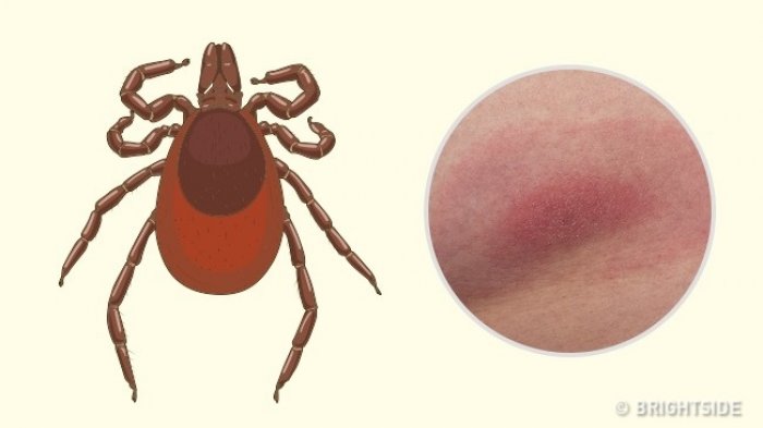 Mendadak Kulitmu Bengkak Habis Kena Gigit? Kenali 7 Macam Gigitan ...