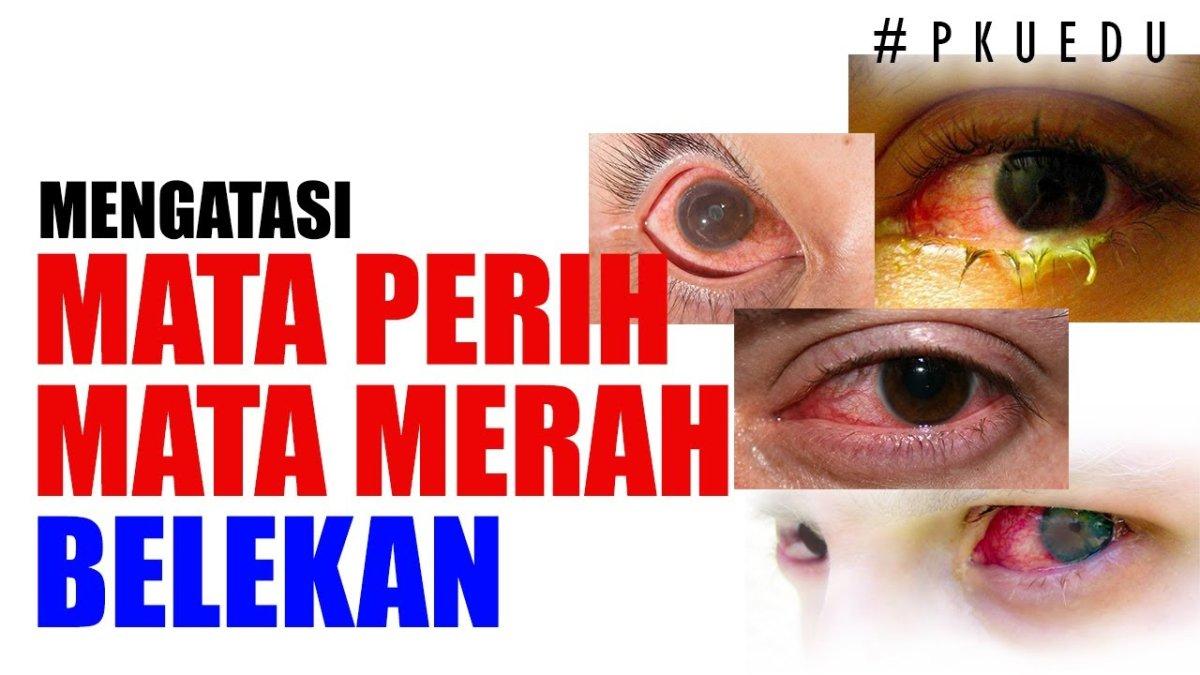 5 Cara Mudah Menyembuhkan Mata Merah, Akibat Debu, Infeksi atau Iritasi ...
