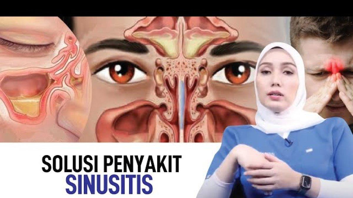 5 Cara Mudah dan Ampuh Mengatasi Penyakit Sinus dengan Cepat Tanpa ...