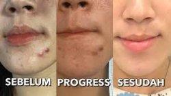 5 Cara Mudah dan Ampuh Mengobati Jerawat Batu Secara Alami Agar Cepat ...
