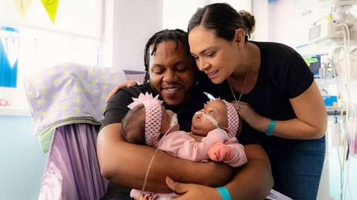 DRAMATIS Bayi Kembar Siam Berhasil Dipisahkan Lewat Operasi Selama 11 Jam, Begini Kondisinya ...