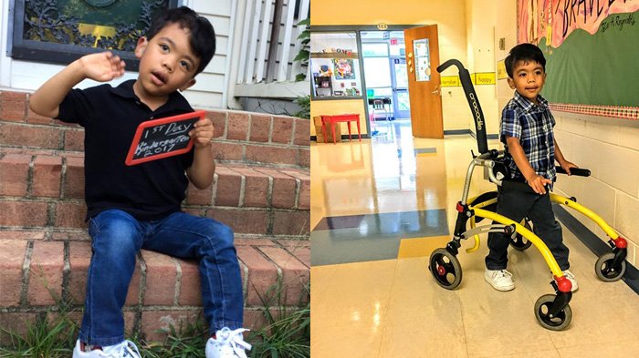 Masih 5 Tahun, Bocah Ini Telah Jalani 22 Operasi Otak, Ada Alasan ...