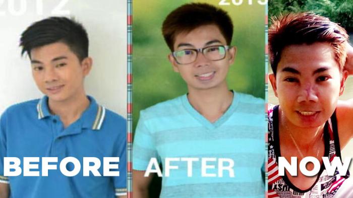 Operasi Plastik Gagal - Kasihan, Model ini Sudah Ganteng Malah Dipermak ...