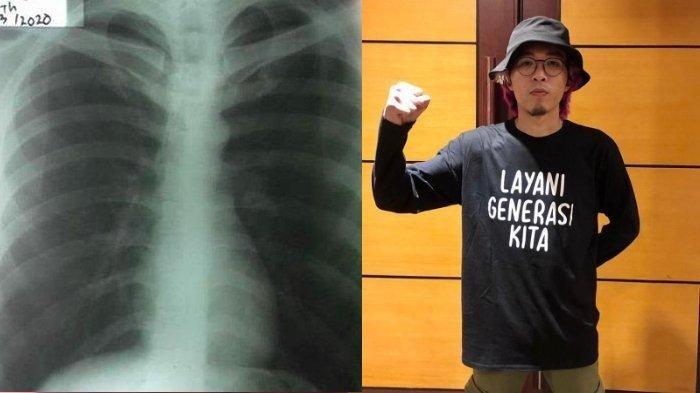 Foto Rontgen Paru-paru dr Tirta yang Tak Sehat Karena Merokok, Kini Ia ...