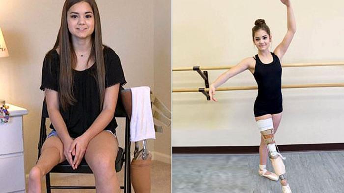 Keren! Meski Kaki Diamputasi, Gadis Ballerina Ini Kembali Menari Lho ...