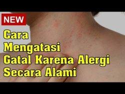 5 Cara Mengatasi Kulit Gatal karena Air Comberan Pakai, Minyak Kelapa ...