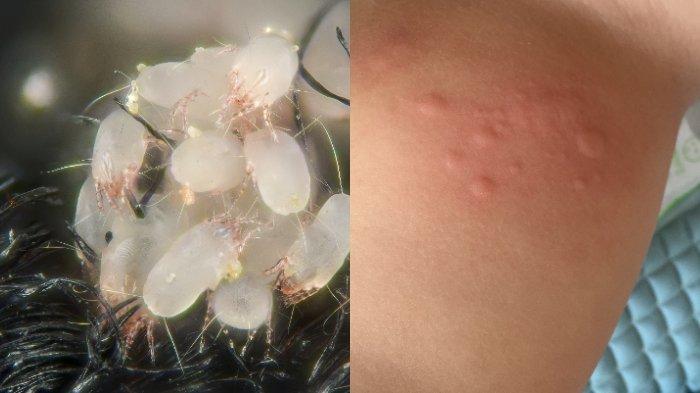 Waspada Tungau Debu! Hewan Kecil Tak Terlihat, Suka Makan Serpihan ...