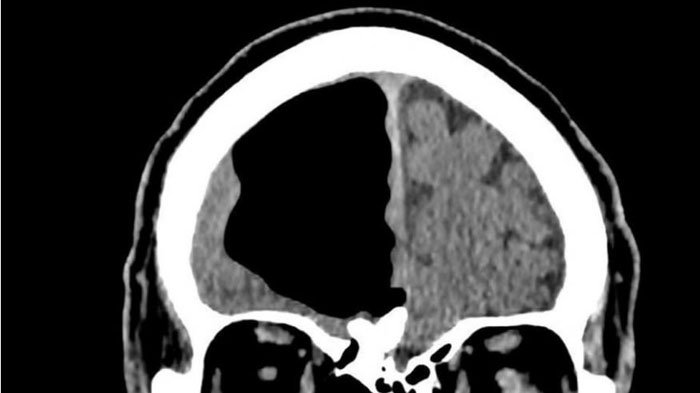 Dinyatakan Sehat, Dokter Syok saat Lihat Hasil CT Scan Tunjukkan Otak ...