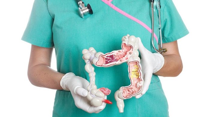 Kanker Kolorektal - 5 Tanda yang Perlu Perempuan Tahu, Mulai dari ...