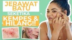 5 Cara Mengobati Jerawat Batu Secara Alami Es Batu, Madu, Pasta Gigi ...