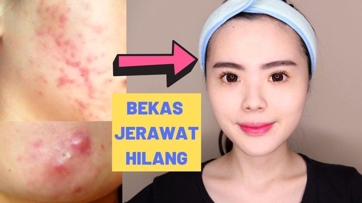 5 Cara Mudah Mengatasi Jerawat Meradang Agar Cepat Kempes dengan ...
