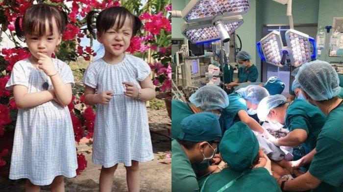 DUA Tahun Lalu Berhasil Dipisah, Bayi Kembar Siam Kini Tumbuh Sehat, Kepribadian Bertolak ...