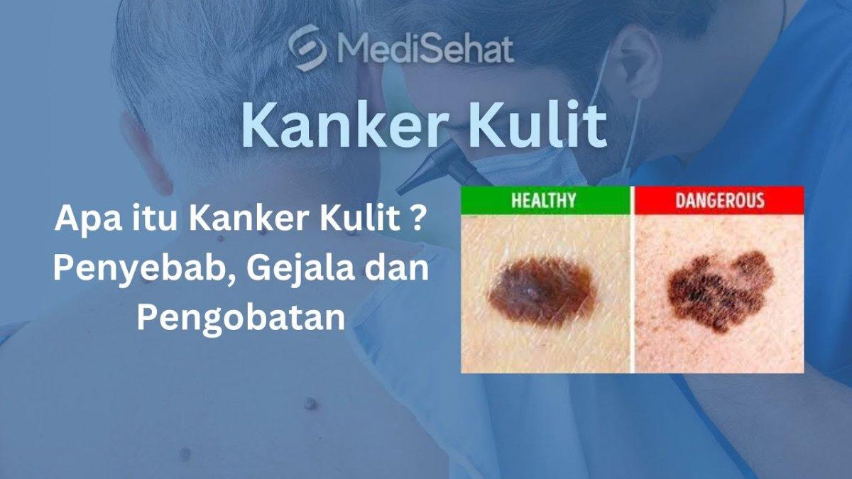 5 Cara Mengobati Kanker Kulit Dengan Pembekuan, Operasi Eksisi ...