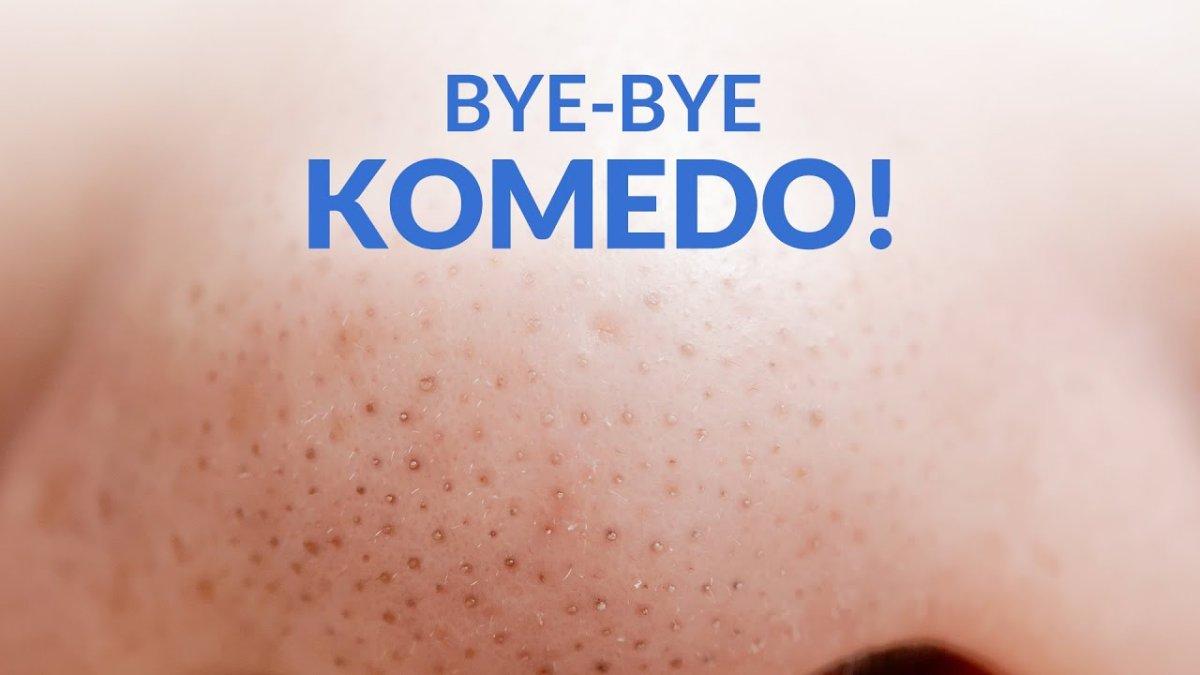 7 Cara Mudah Menghilangkan Komedo di Wajah, Hempas Kotoran Tersembunyi ...