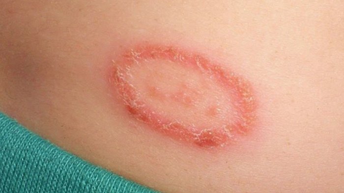 Kurap Memang Penyakit Kulit Yang Memalukan, Obati Dengan Lengkuas Ini ...