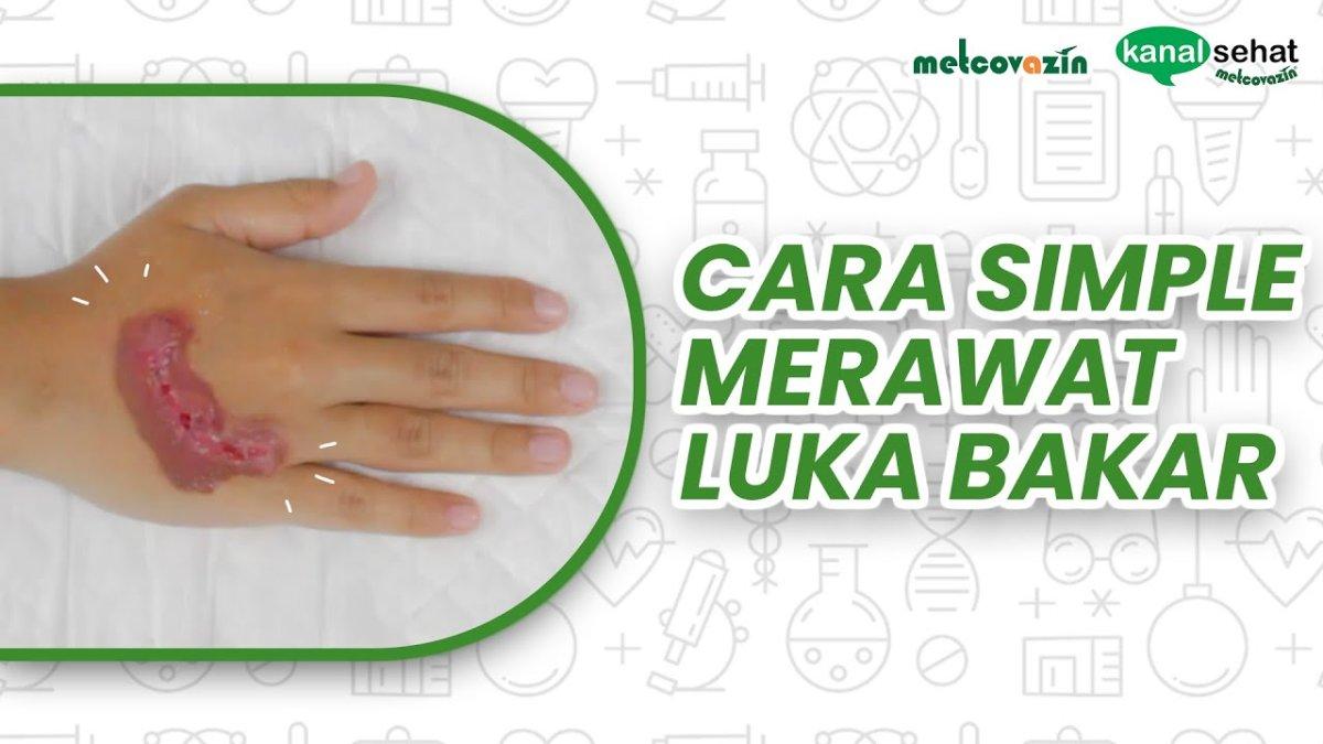 5 Cara Mengobati Luka Bakar Secara Alami Bersihkan Luka, Kompres Air Dingin, Dijamin Sembuh ...
