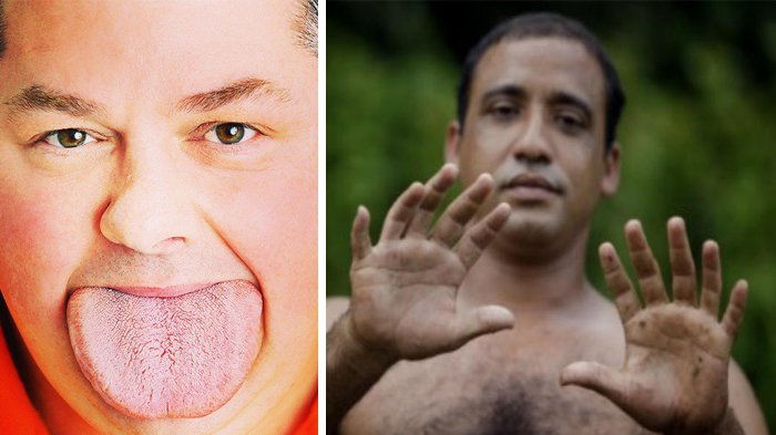 Alamak! 10 Orang Ini Alami Mutasi Paling Aneh, Lihat Kondisinya Bikin ...