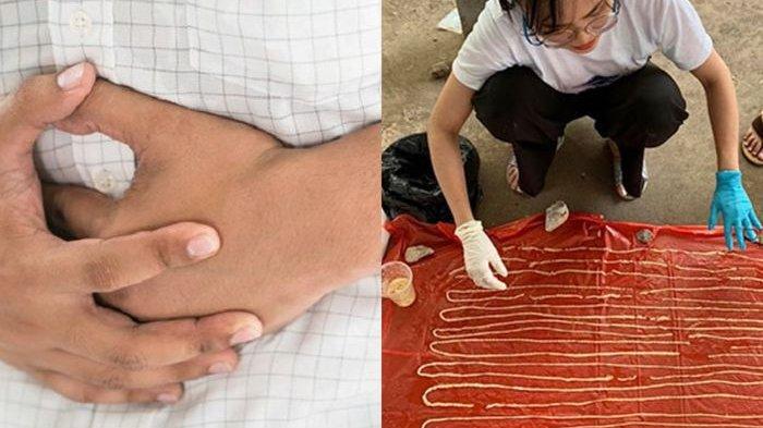 MAKAN Daging Sapi, Pria Ini Kesakitan Keluarkan Cacing Panjang 18 Meter ...