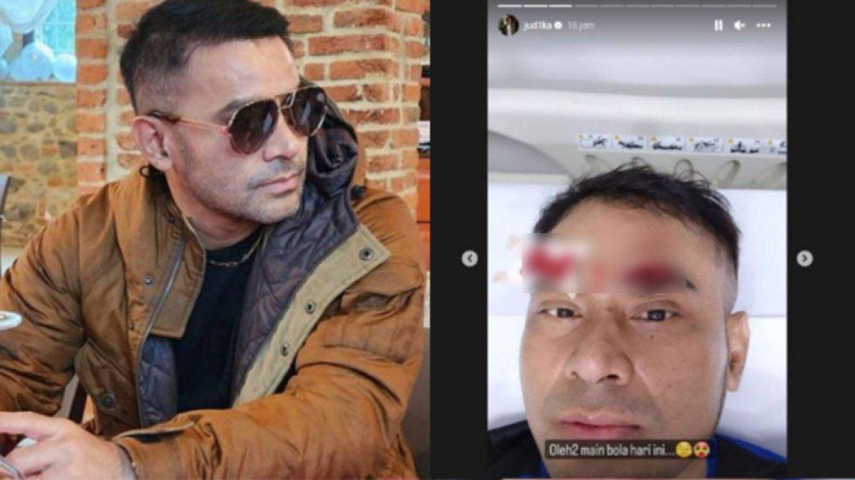 Judika Alami Kecelakaan, Pelipis Mata Robek hingga Keluar Banyak Darah ...